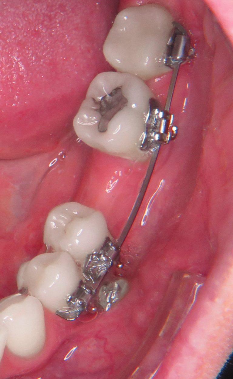 Präprothetische Kieferorthopädie - KFO Langen